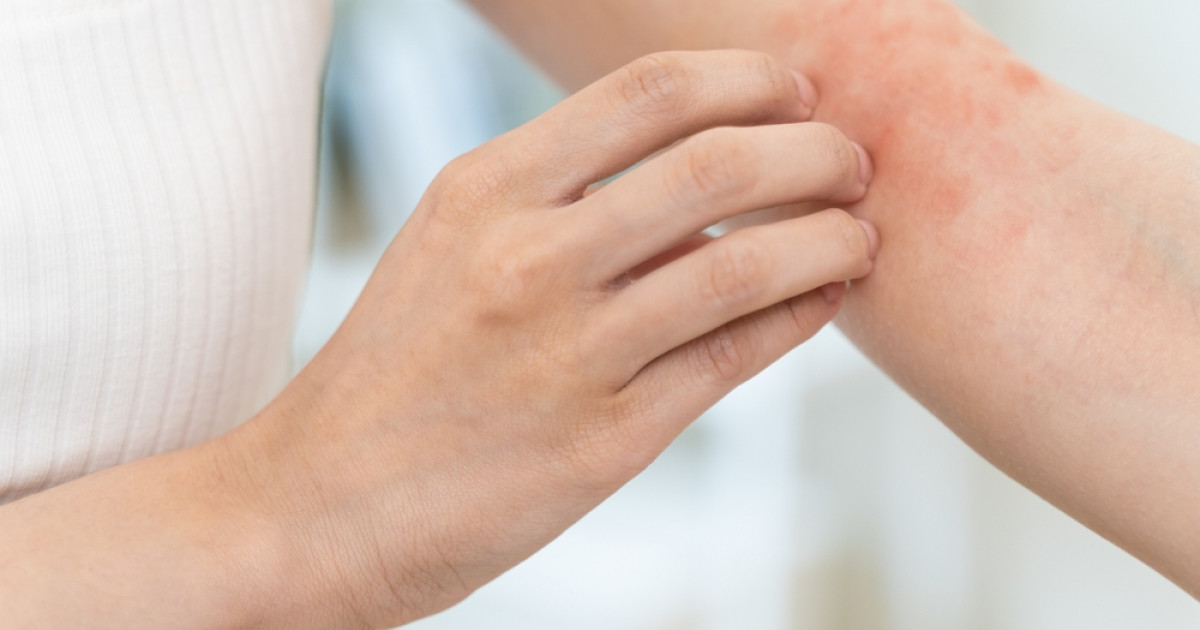 Šta je atopijski dermatitis